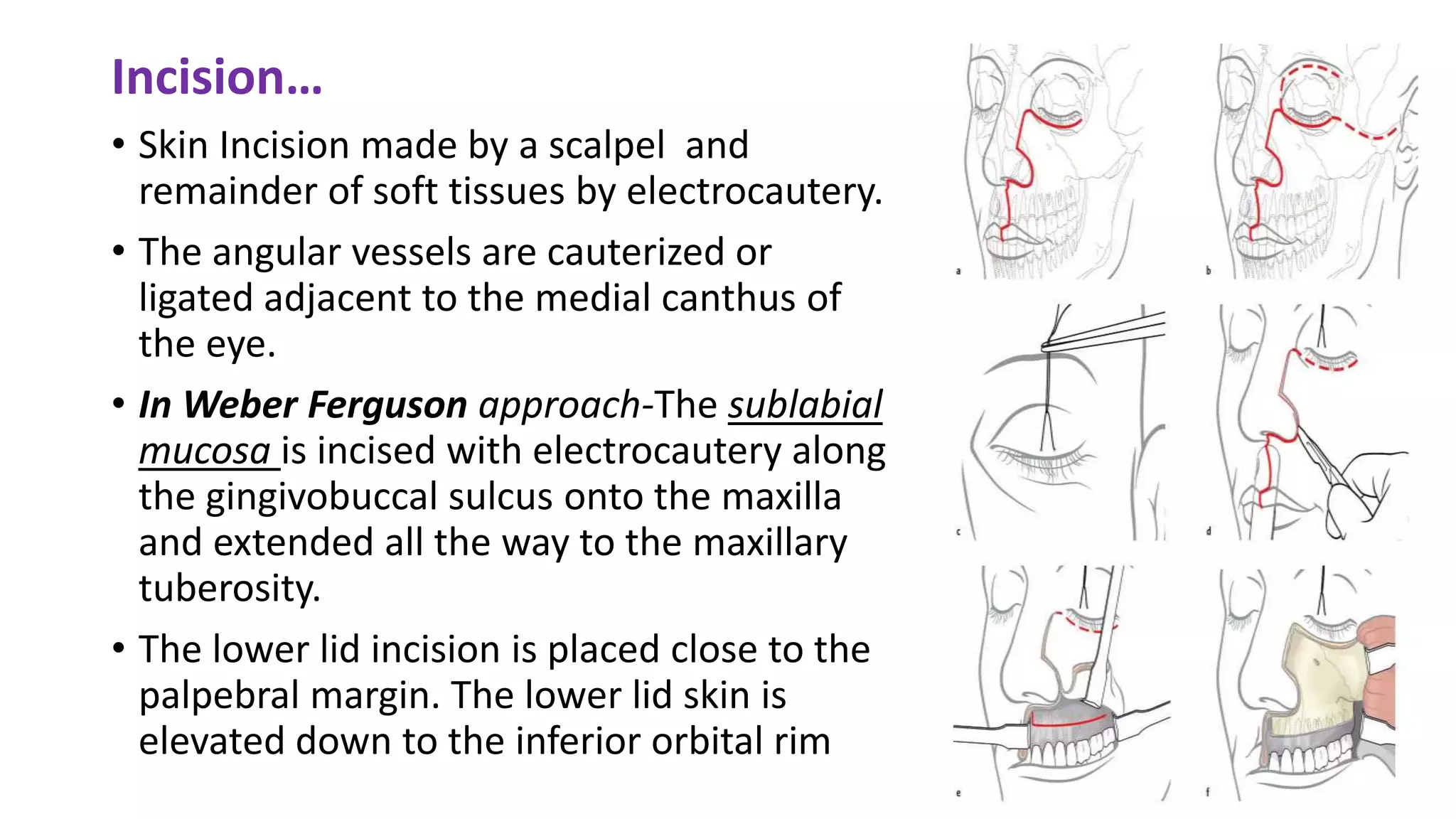1. MAXILLECTOMY.pptx