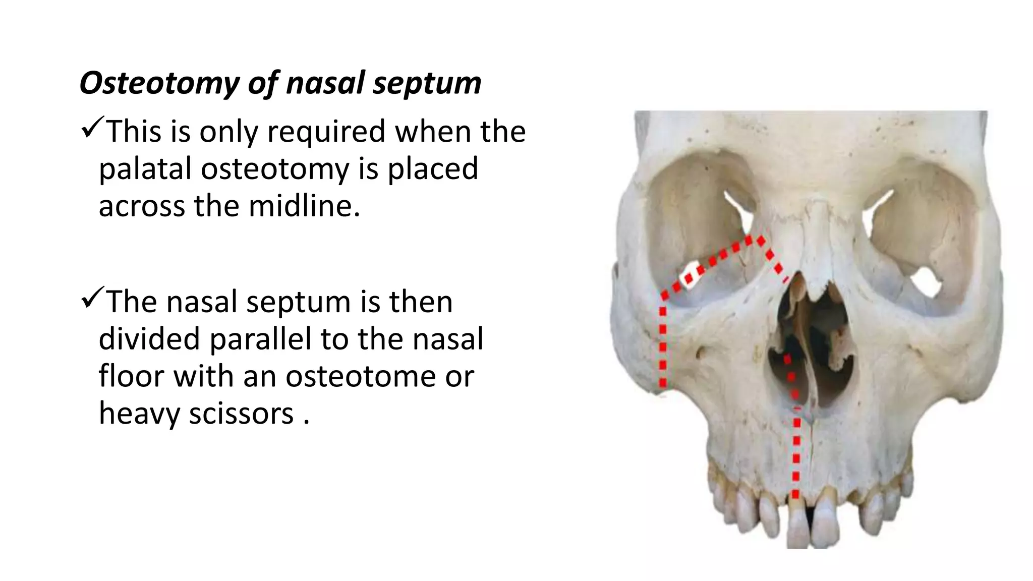 1. MAXILLECTOMY.pptx
