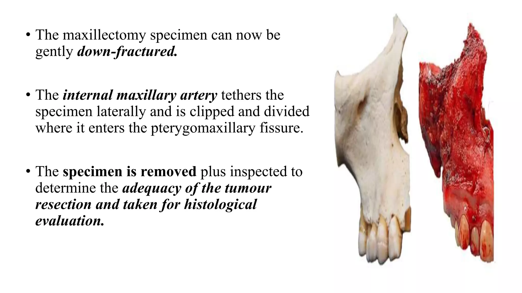 1. MAXILLECTOMY.pptx