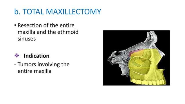 1. MAXILLECTOMY.pptx