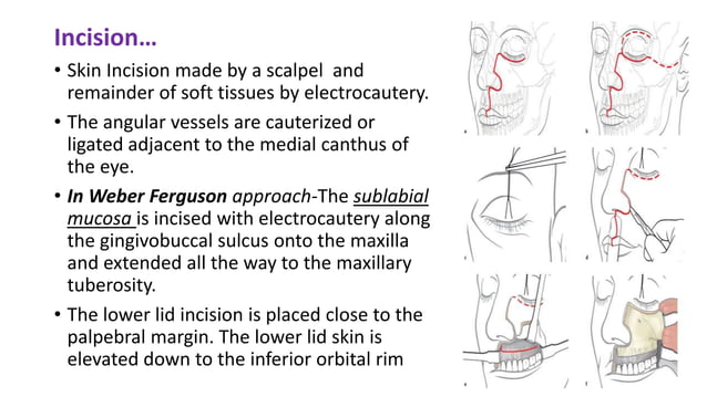 1. MAXILLECTOMY.pptx