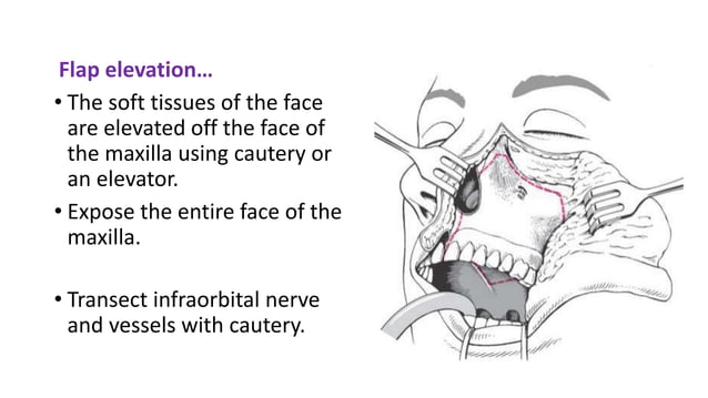 1. MAXILLECTOMY.pptx