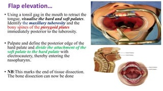 1. MAXILLECTOMY.pptx