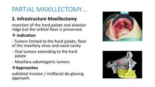 1. MAXILLECTOMY.pptx