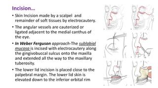 1. MAXILLECTOMY.pptx