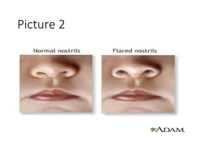 1. NOSE FLARING by wilson ochogu -WPS Office.pptx