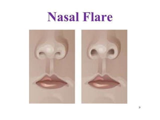 1. NOSE FLARING by wilson ochogu -WPS Office.pptx
