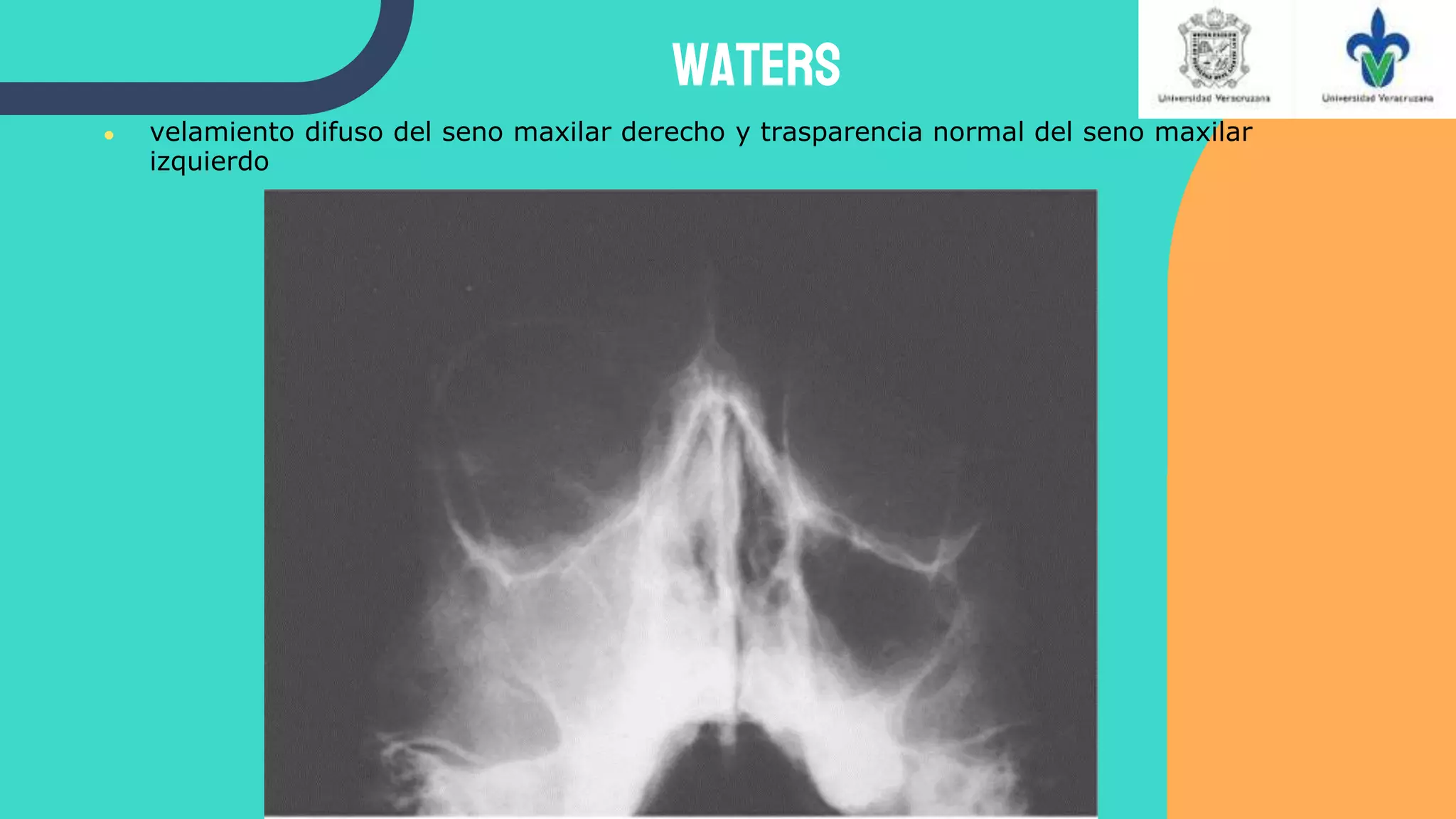 1. SINUSITIS CASO CLINICO CON CORRELACION RADIOLOGICA.pptx