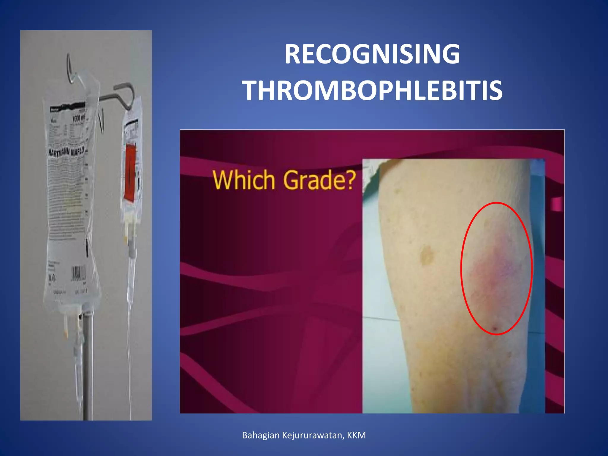 Recognising thrombophlebitis | PPTX