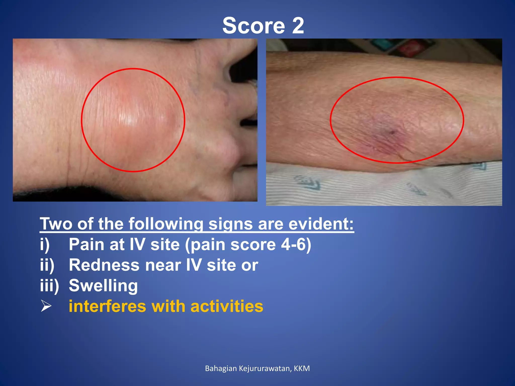 Recognising thrombophlebitis | PPTX