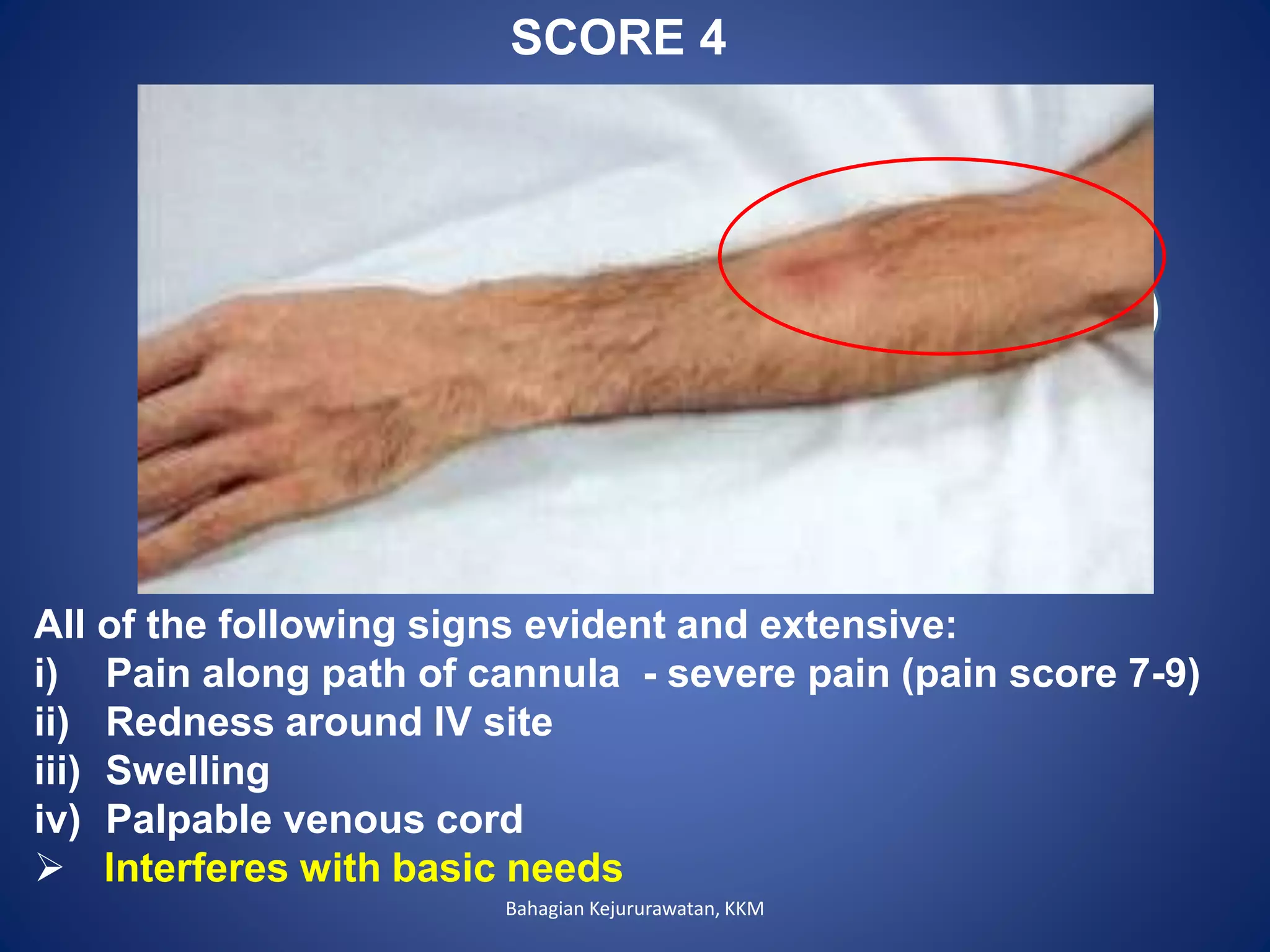Recognising thrombophlebitis | PPTX