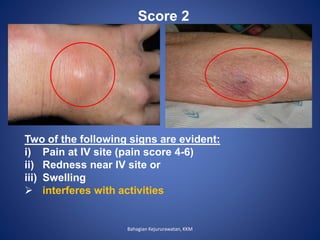 Recognising thrombophlebitis | PPTX