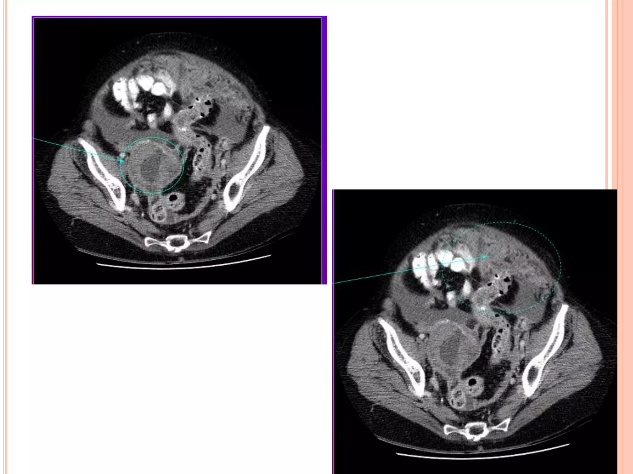 1. ca ovary staging etiology pathogenesis.pptx