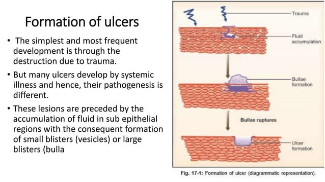 Ulcerative, Vesicular and Bullous Lesions.pptx | Digestive Disorders ...