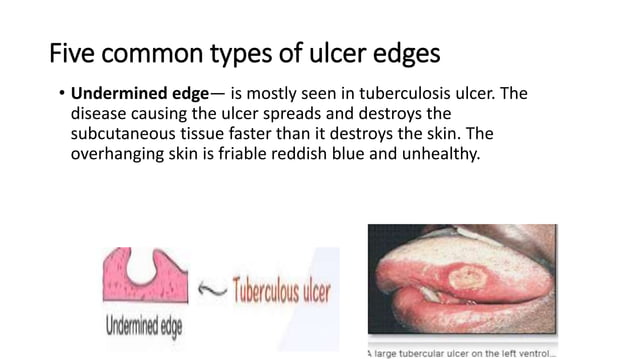 Ulcerative, Vesicular and Bullous Lesions.pptx | Digestive Disorders ...