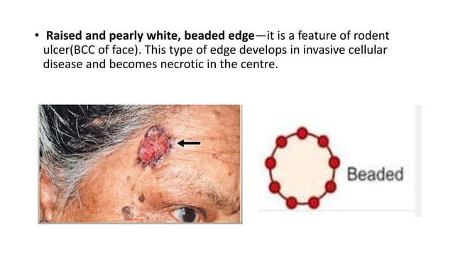 Ulcerative, Vesicular and Bullous Lesions.pptx | Digestive Disorders ...