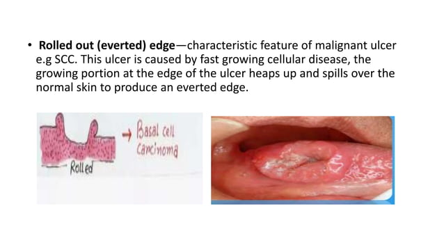 Ulcerative, Vesicular and Bullous Lesions.pptx | Digestive Disorders ...