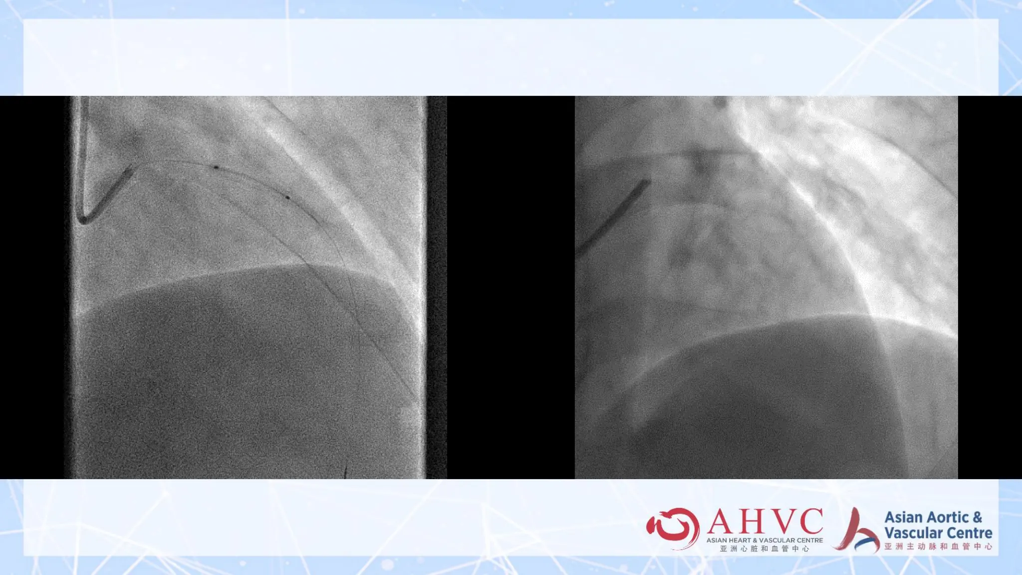 Heart Stent Procedure Demystify - By Dr Tan Chong Hiok | PDF | Heart ...