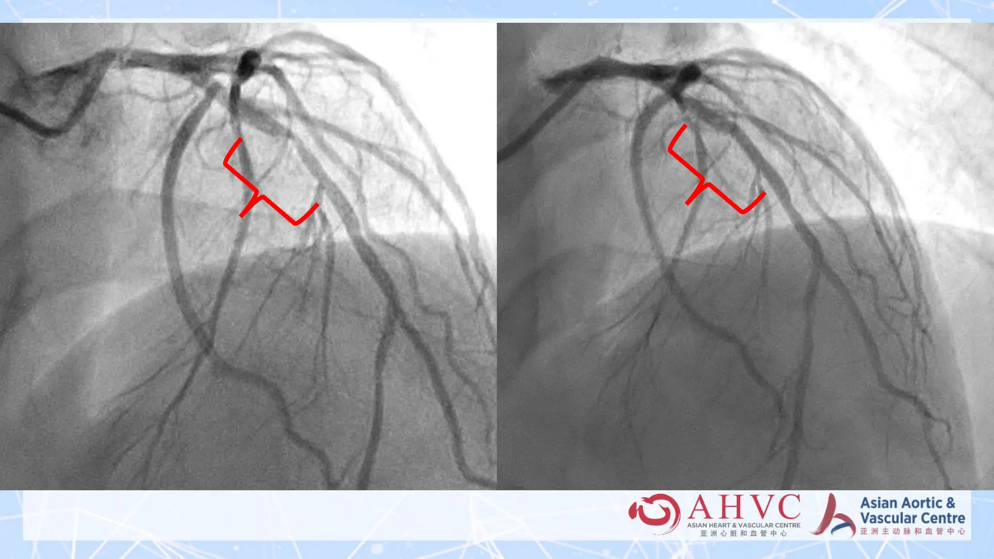 Heart Stent Procedure Demystify - By Dr Tan Chong Hiok | PDF | Heart ...