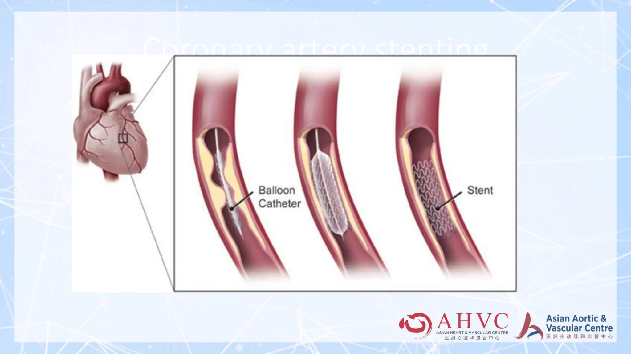 Heart Stent Procedure Demystify - By Dr Tan Chong Hiok | PDF | Heart ...