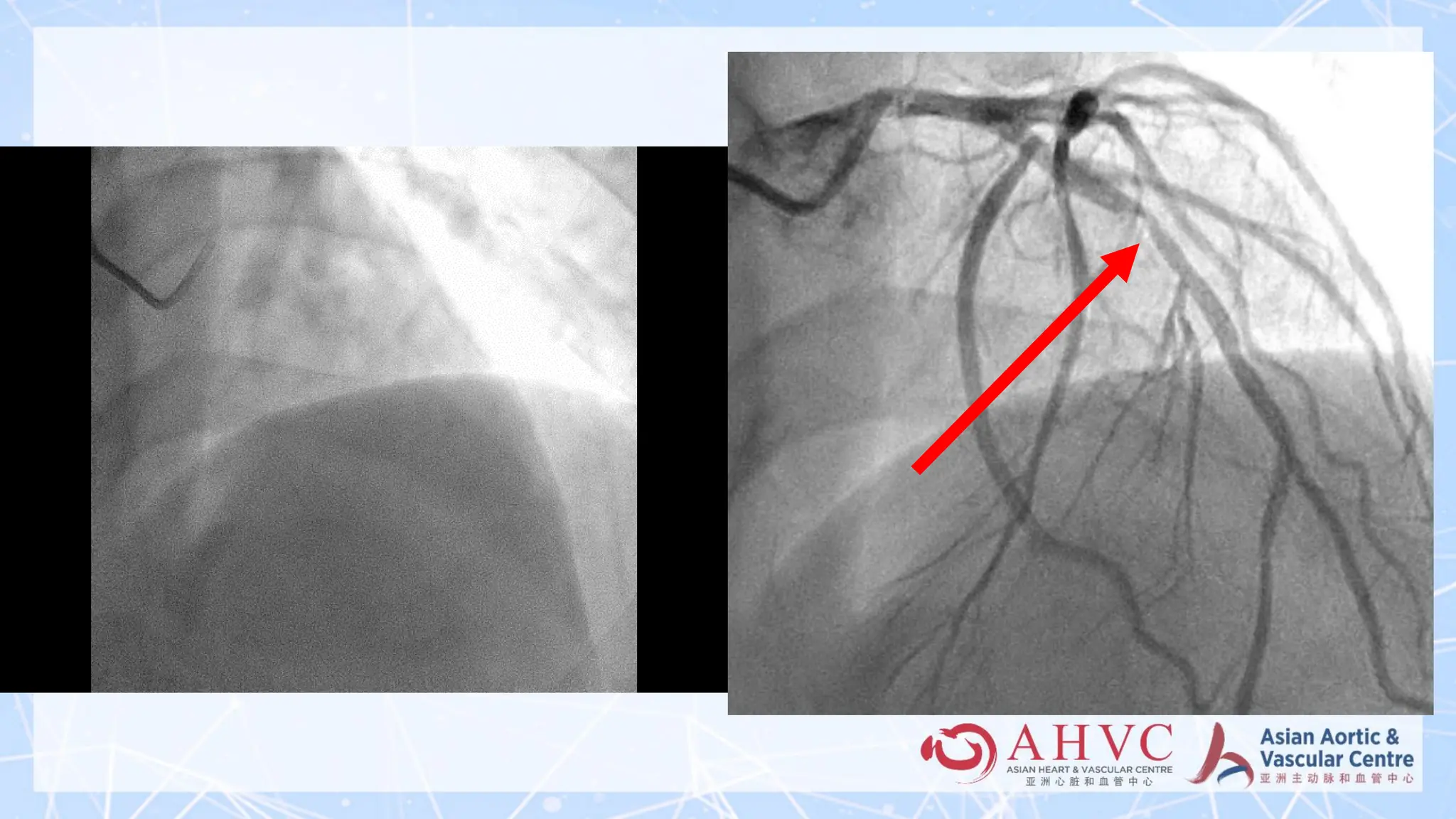 Heart Stent Procedure Demystify - By Dr Tan Chong Hiok | PDF | Heart ...