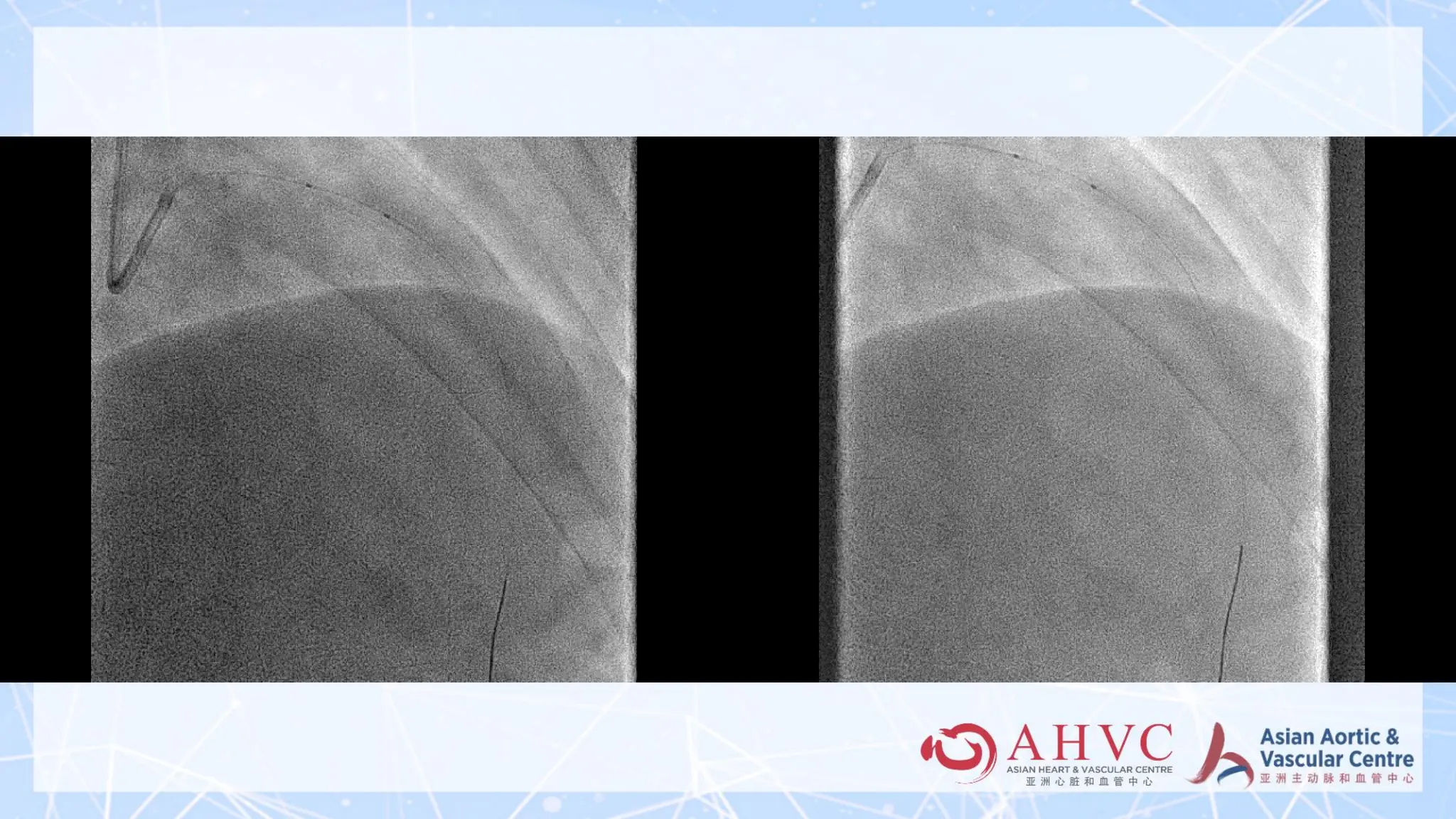 Heart Stent Procedure Demystify - By Dr Tan Chong Hiok | PDF | Heart ...