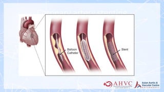 Heart Stent Procedure Demystify - By Dr Tan Chong Hiok | PDF | Heart ...