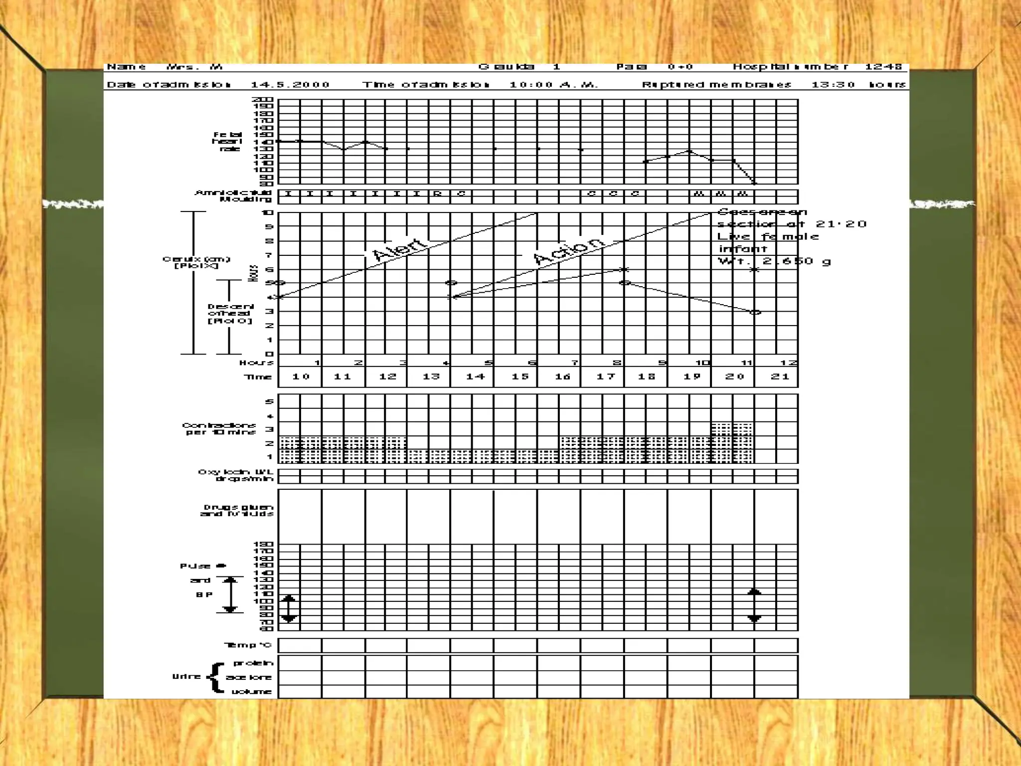PENGGUNAAN PARTOGRAF Dalam Persalinan dan pertolongan | PPT
