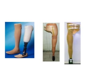 1.PROSTHETIC COMPONENTS.ppt for rehabbbx | PPTX | Foot Health ...