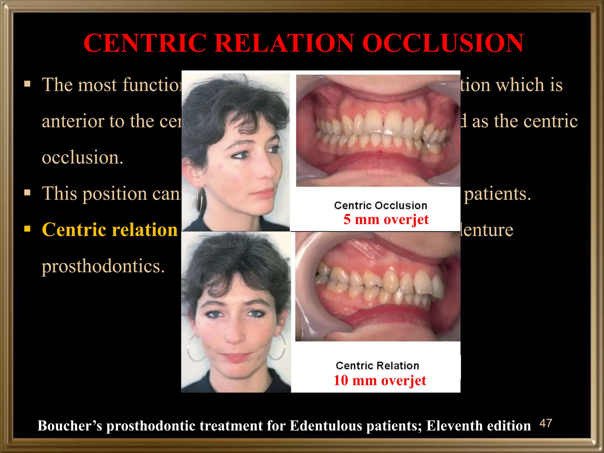 1. Biomechanics of edentulous state.pptx