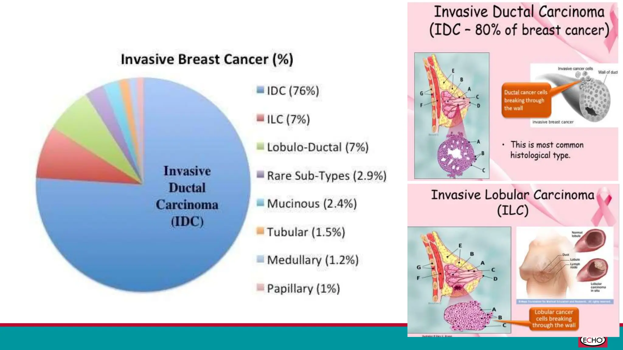 Breast Cancer- introduction, patho,signs-sympt.pptx