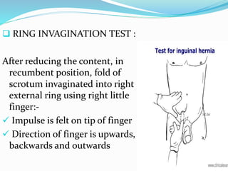1.INDIRECT INGUINAL HERNIA CASE PRESENTATION.pptx