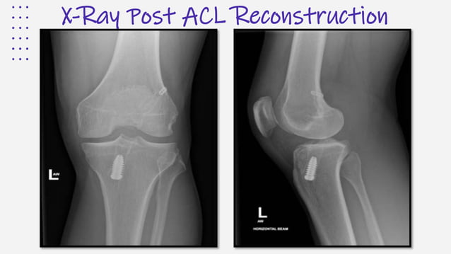 1.Update on ACL injuries and management NOOR AZMI MN (2).pptx | Death ...
