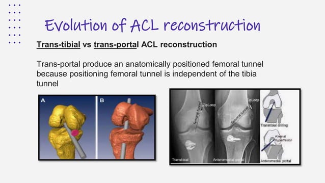 1.Update on ACL injuries and management NOOR AZMI MN (2).pptx | Death ...