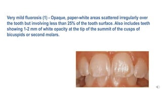 Deans Fluorosis Index powerpoint presentation | PPTX