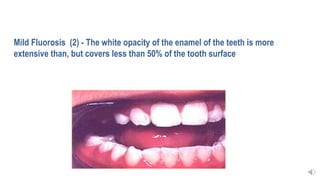 Deans Fluorosis Index powerpoint presentation | PPTX