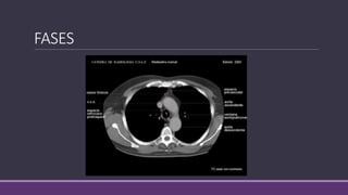 1. TOMOGRAFIA TORACICA tac pulmonar y oseo | PPTX