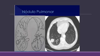 1. TOMOGRAFIA TORACICA tac pulmonar y oseo | PPTX