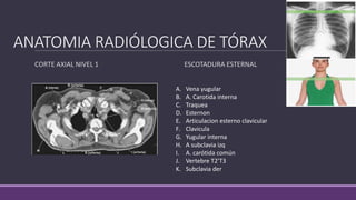 1. TOMOGRAFIA TORACICA tac pulmonar y oseo | PPTX