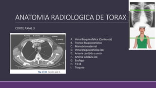 1. TOMOGRAFIA TORACICA tac pulmonar y oseo | PPTX