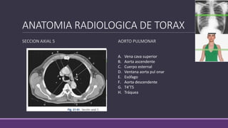 1. TOMOGRAFIA TORACICA tac pulmonar y oseo | PPTX