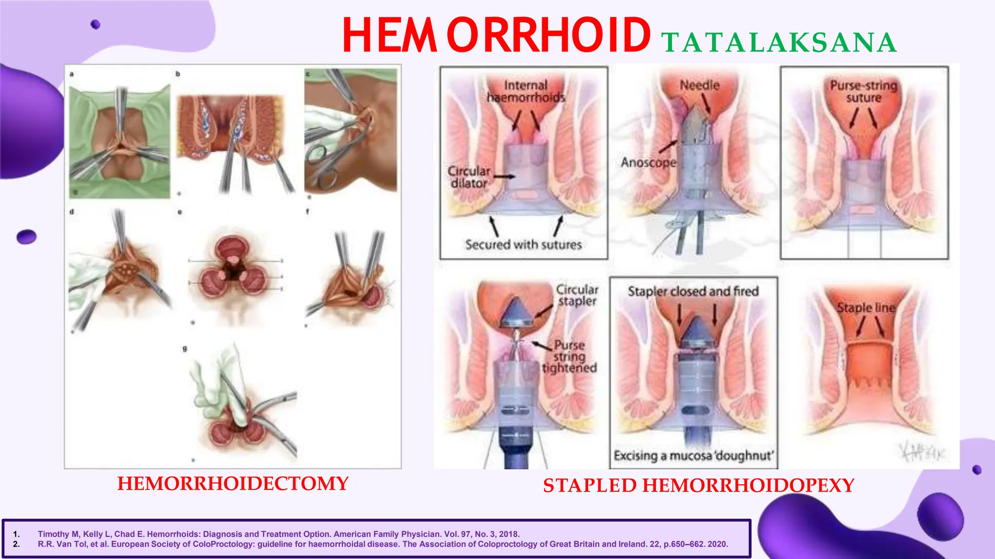 1. Hemoroid hemroud hemoroid hemoroid hemor | PPT