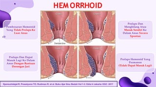 1. Hemoroid hemroud hemoroid hemoroid hemor | PPT