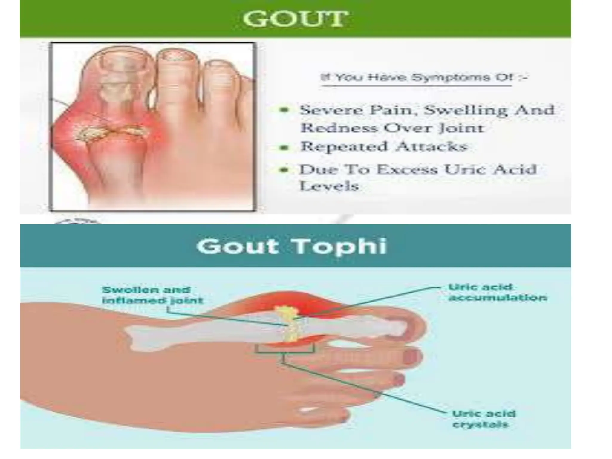 1.Diseases of Bones nad joints Pathophysiology(RA Gout).pptx | Bone and Joint Conditions ...