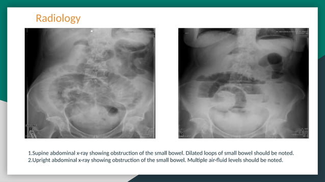 1.CONSERVATIVE MANAGEMENT OF ADHESIVE INTESTINAL OBSTRUCTION 2.pptx