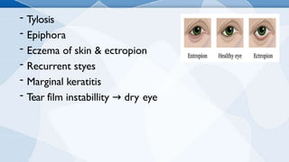 Blepharitis is a common eye condition that causes inflammation of the ...