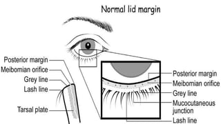 Blepharitis is a common eye condition that causes inflammation of the ...