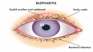 Blepharitis is a common eye condition that causes inflammation of the ...