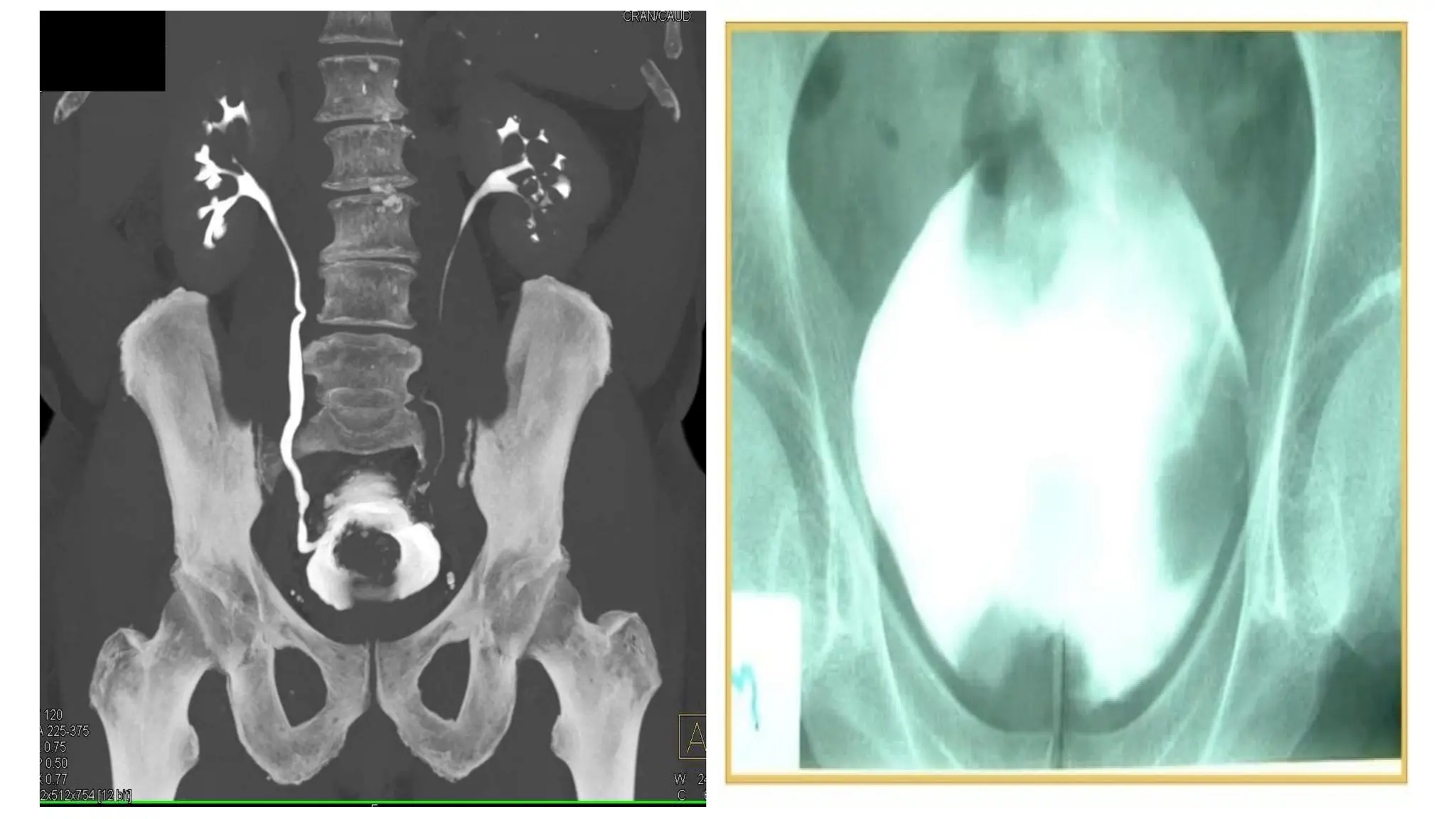 1. Management of bladder cancers....pptx