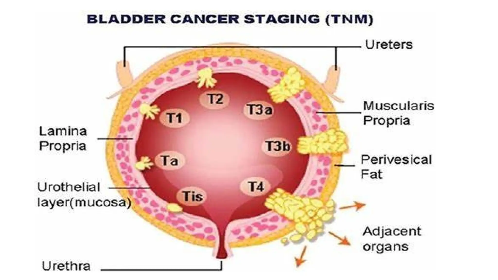1. Management of bladder cancers....pptx